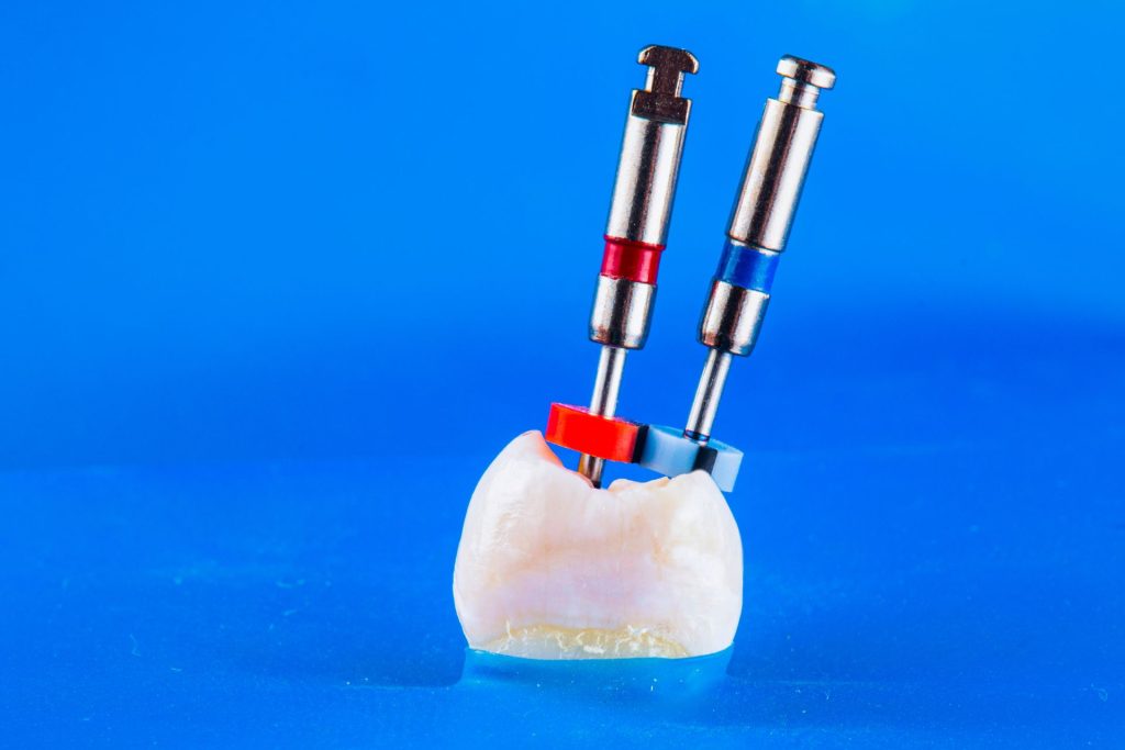 Root Canal Treatment Cyberjaya - Shiny Teeth Dental